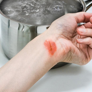 Common Causes Of Burn Injuries In New Jersey | Kronberg Law Firm